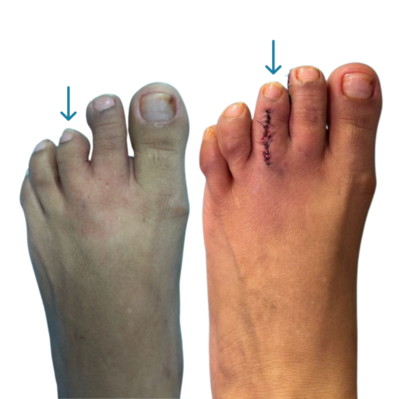 TOE LENGTHENING - CDA Foot and Ankle