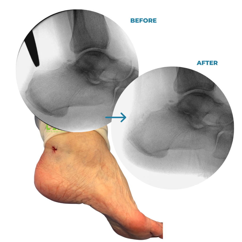 Haglund´s Deformity - CDA Foot and Ankle