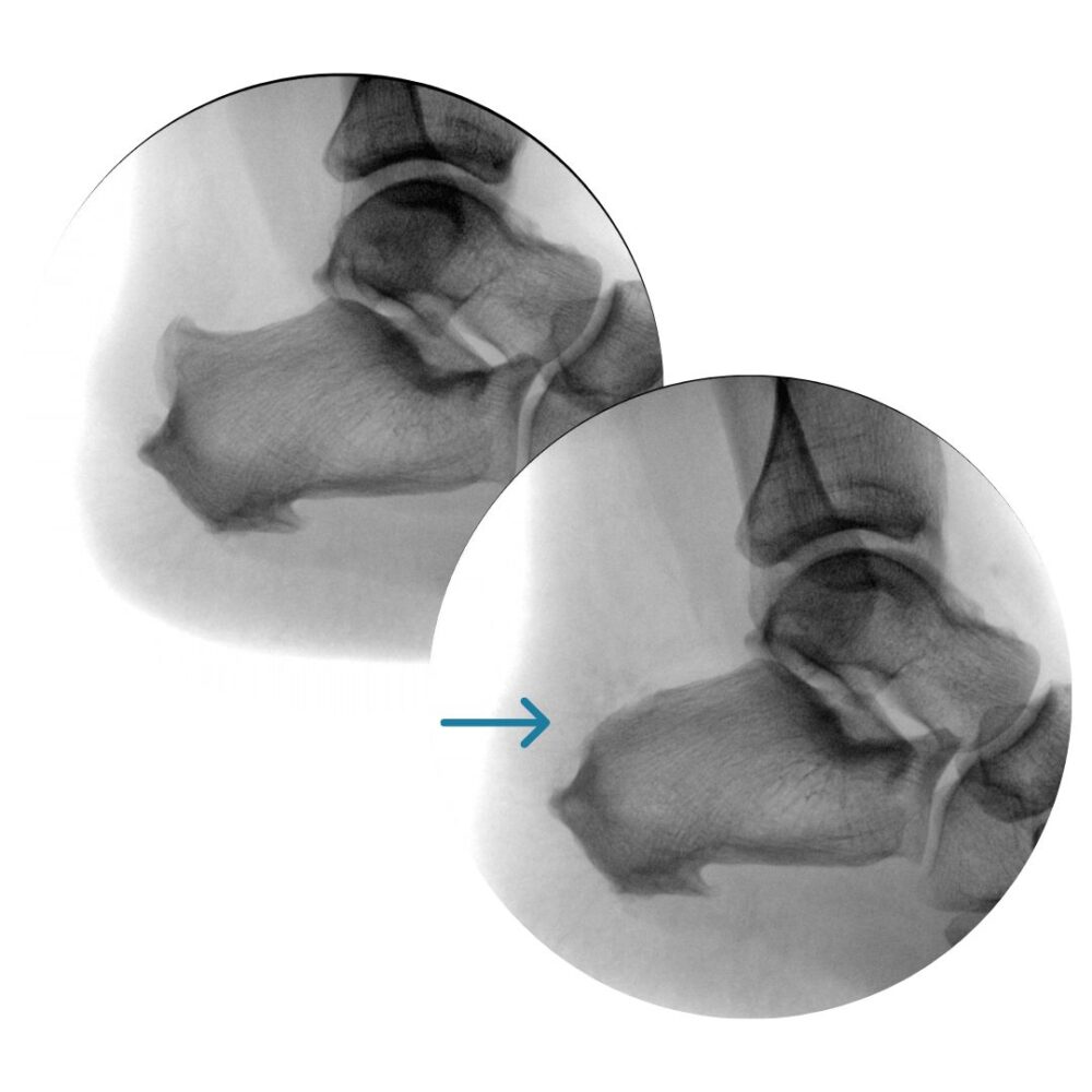 Haglund´s Deformity - CDA Foot and Ankle
