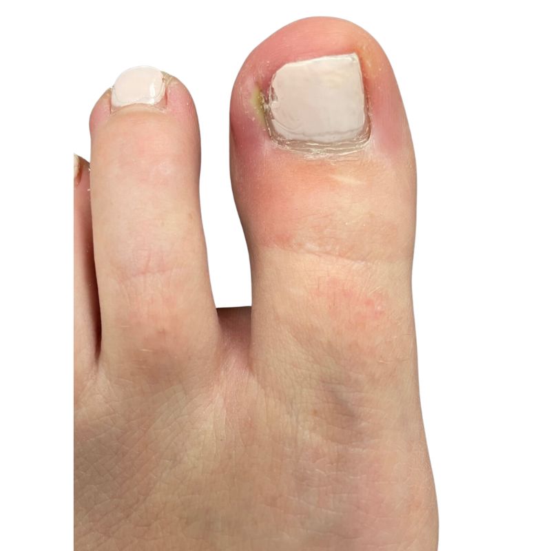 Ingrown Toenails - CDA Foot and Ankle